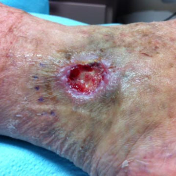 Ulcerations Caused By Chronic Venous Insufficiency - Dialogues in Wound ...