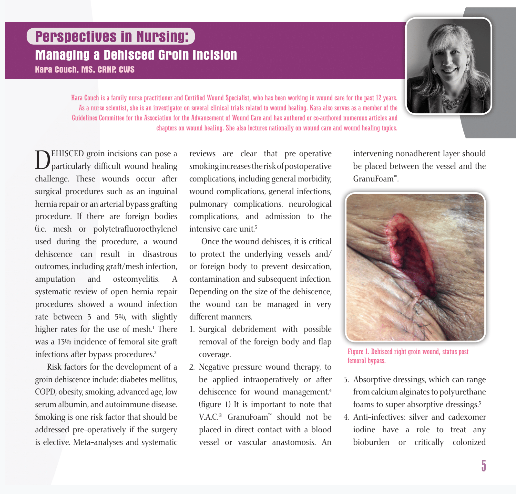 Managing a Dehisced Groin Incision - Dialogues in Wound Management