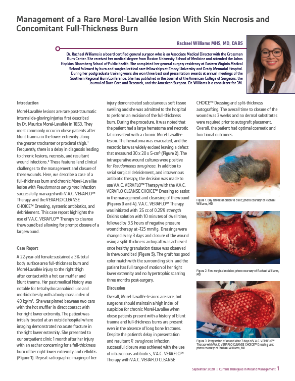 Management of a Rare Morel-Lavallée lesion With Skin Necrosis and ...